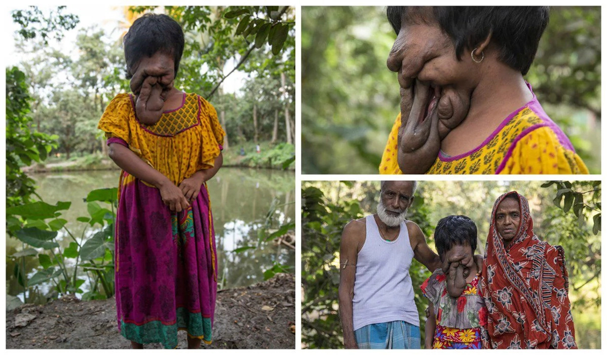 Woman with no face to undergo life-changing operation Tuko.co.ke