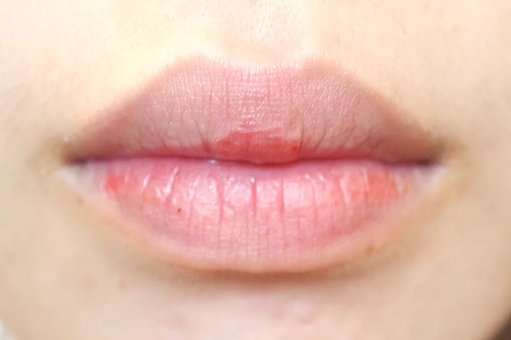 5 Vitamin Deficiencies That Are Written On Your Face And How To Treat It