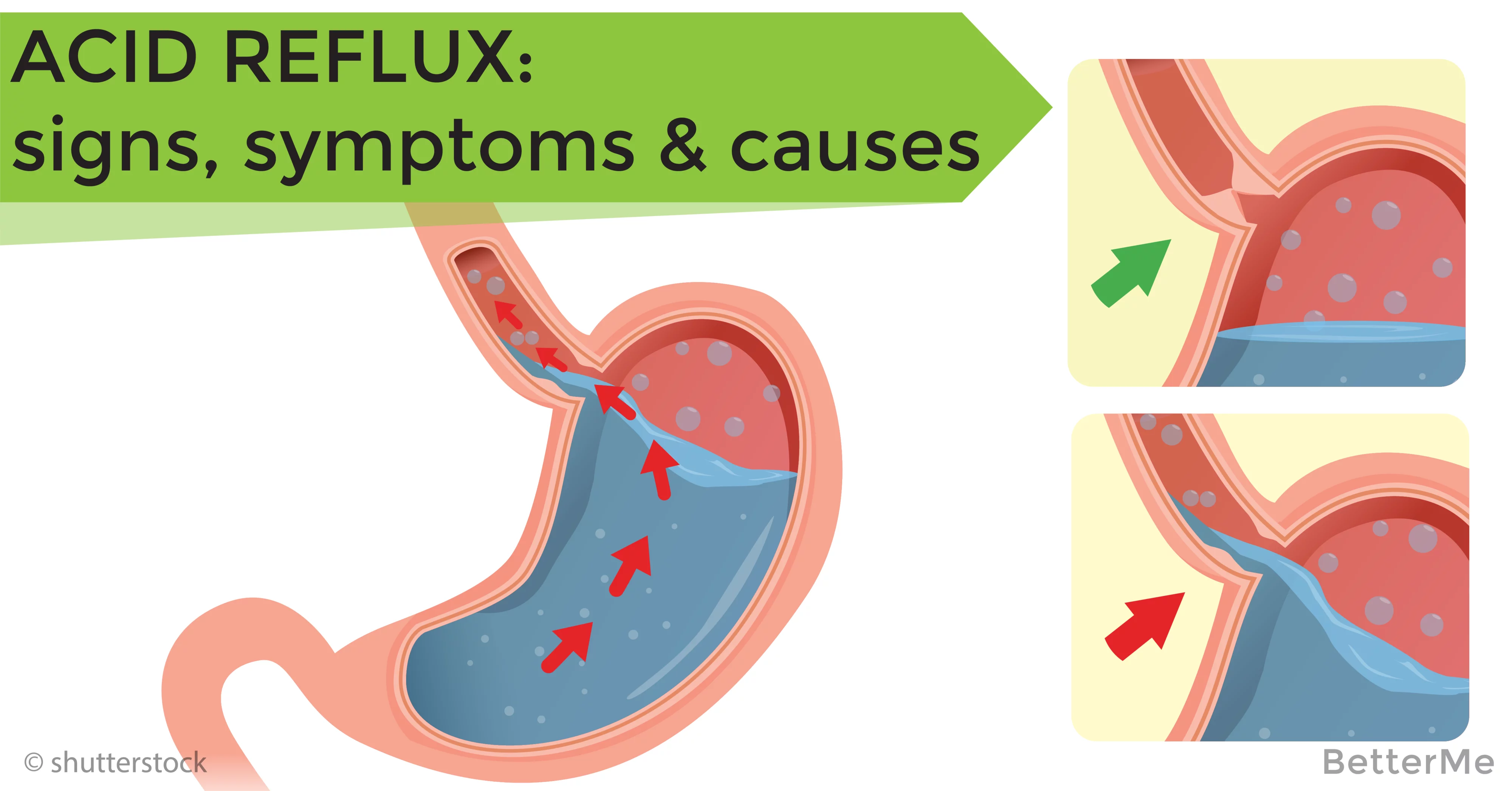 Gastric Reflux